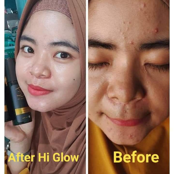 Produk Distributor Hi Glow Skincare | Shopee Indonesia