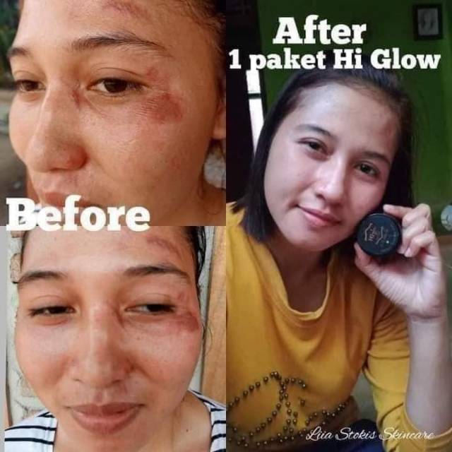 Produk Distributor Hi glow skincare1 | Shopee Indonesia